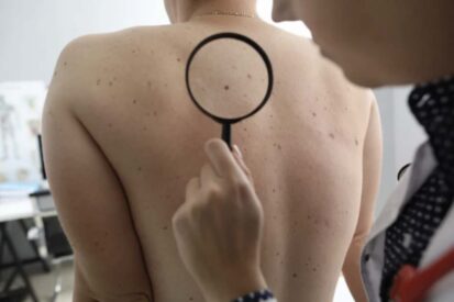 Melanoma e neo? La regola ABCDE può essere d'aiuto per distinguerli ...